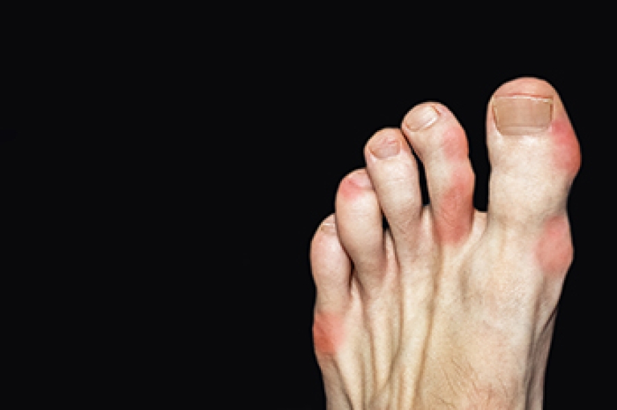 Understanding Chronic Tophaceous Gout