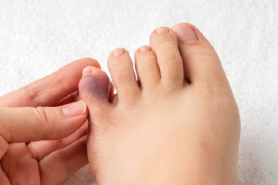 Symptoms and Causes of a Broken Pinky Toe